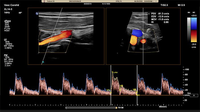 Vascular Ultrasound System Portfolio | Philips
