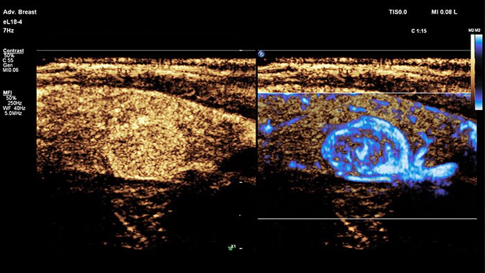 CEUS Contrast-Enhanced Ultrasound | Philips